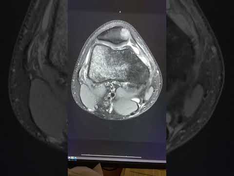 Transient patellar dislocation classic case