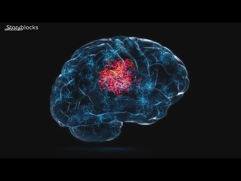 No, a brain hemorrhage is not always fatal