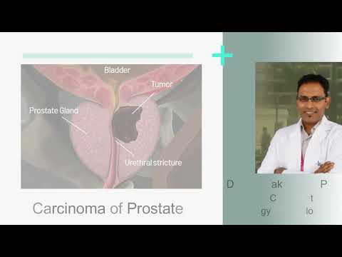 Carcinoma Prostate | Sakra World Hospital
