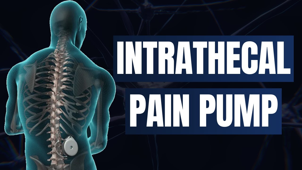 What you need to know about Intrathecal Pain Pump
