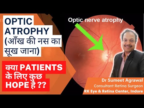 OPTIC ATROPHY : आँख की नस का सूख जाना ! क्या हमेशा के लिए रोशनी हो जाएगी ख़तम ?