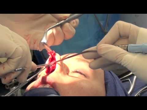 Rhinoplasty in Chevy Chase, MD | Philip Schoenfeld MD, FACS