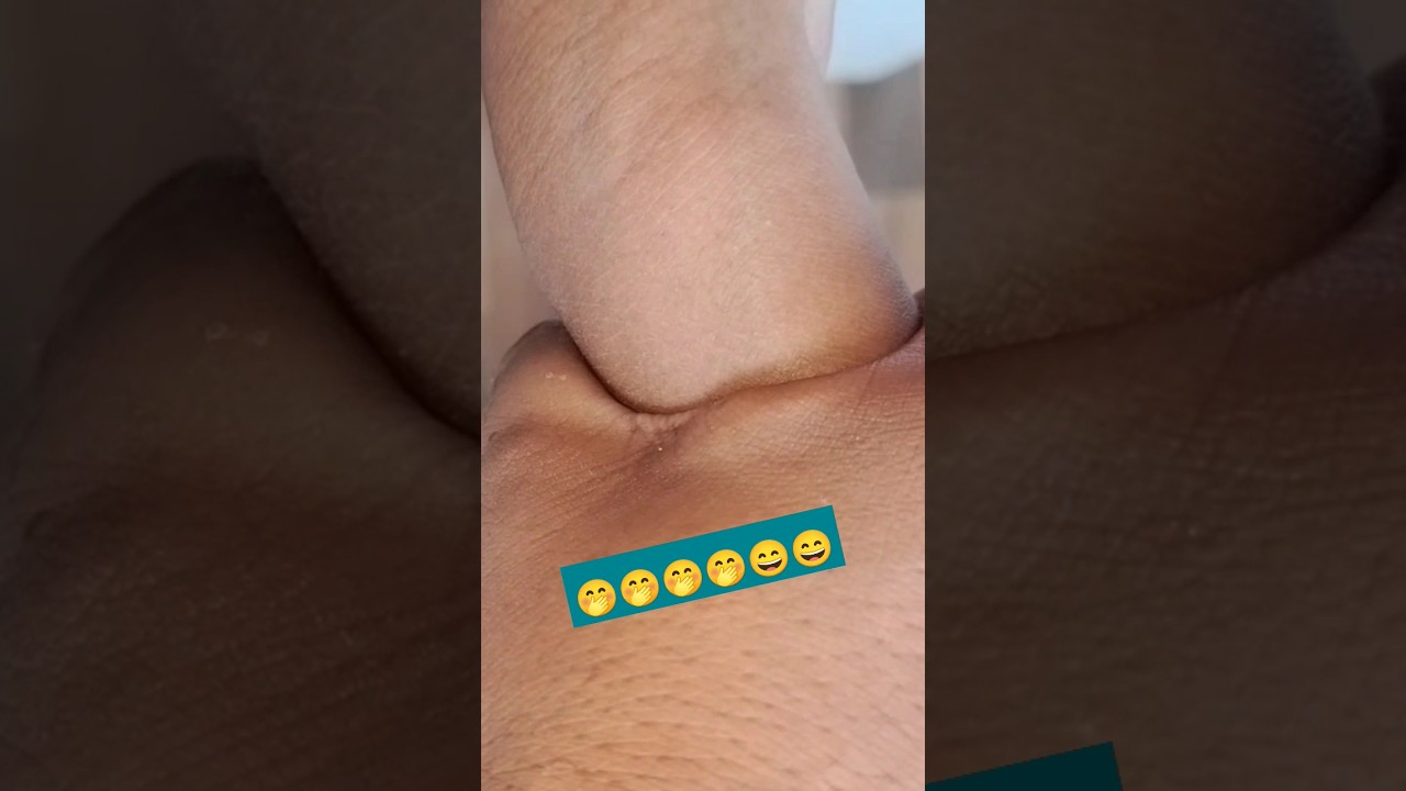 Cannulation.. video.. part 359 #shorts #viral #trending #2023