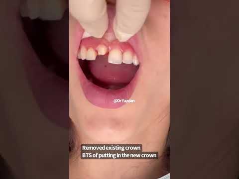 Front tooth crown | porcelain crown procedure | dental crown | Dr. Yazdan #cosmeticdentistry