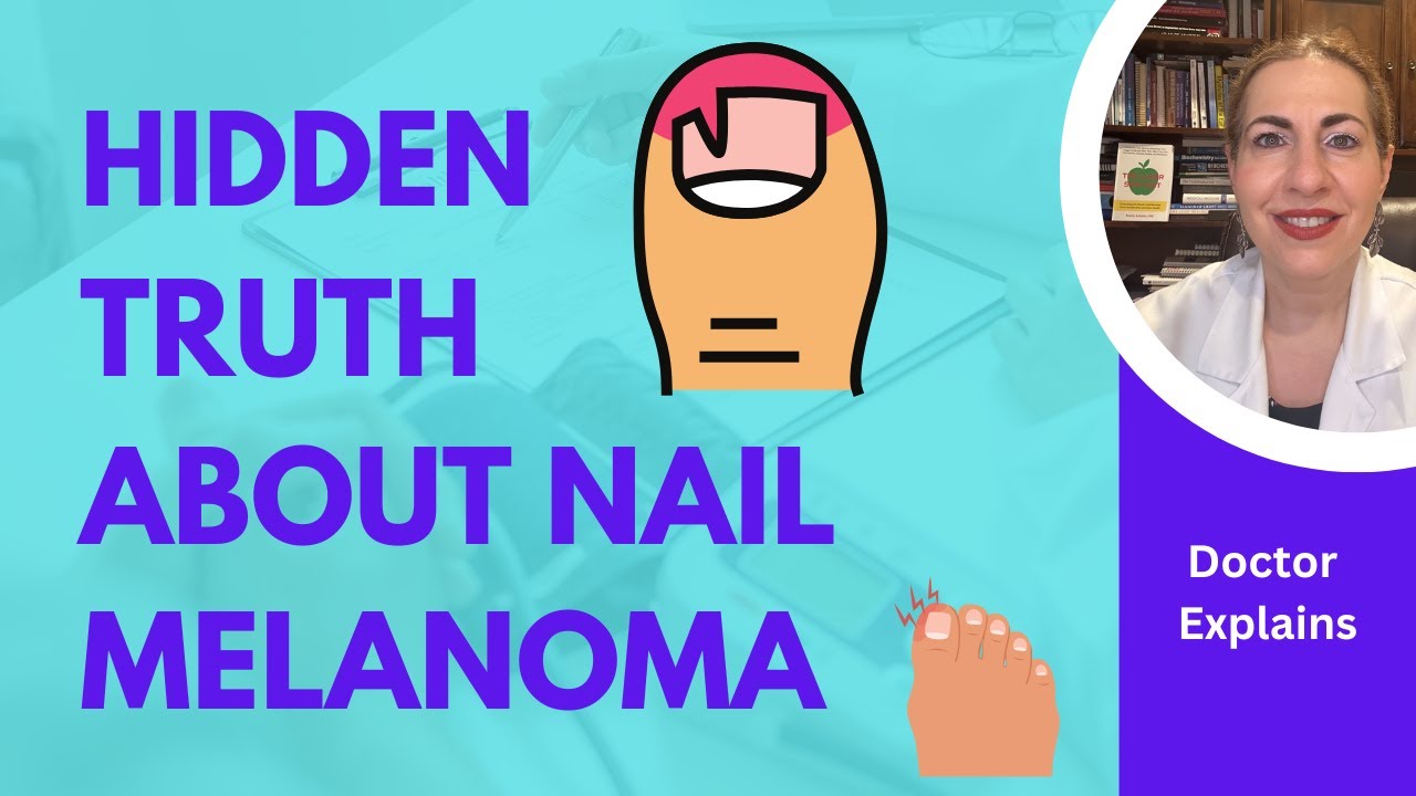 NAIL Melanoma ALERT What You MUST Know! Doctor Explains