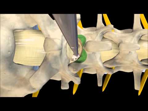 Orthopedic Pain Specialists and Dr Tim Davis Present Totalis Lumbar Decompression System