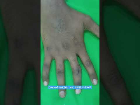 Finger Fracture #hand #physiotherapy #middlefinger #littelfinger#Fingersplint #stiffness #plaster