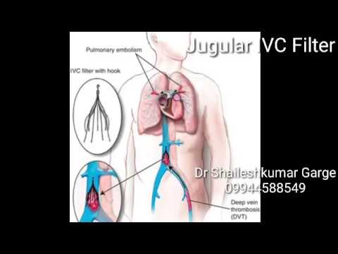 IVC filter jugular route | Pulmonary Embolism prevention | DVT complication prevention by Dr shailes