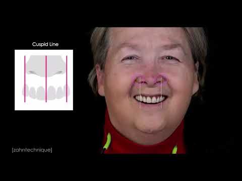 Removable Webinar Series_Module 2 - Analog Removable Full Dentures and Partial Dentures Webinar