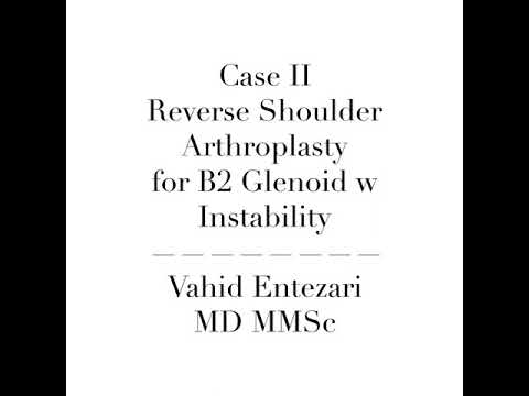 Reverse total shoulder arthroplasty for B2 glenoid with instability
