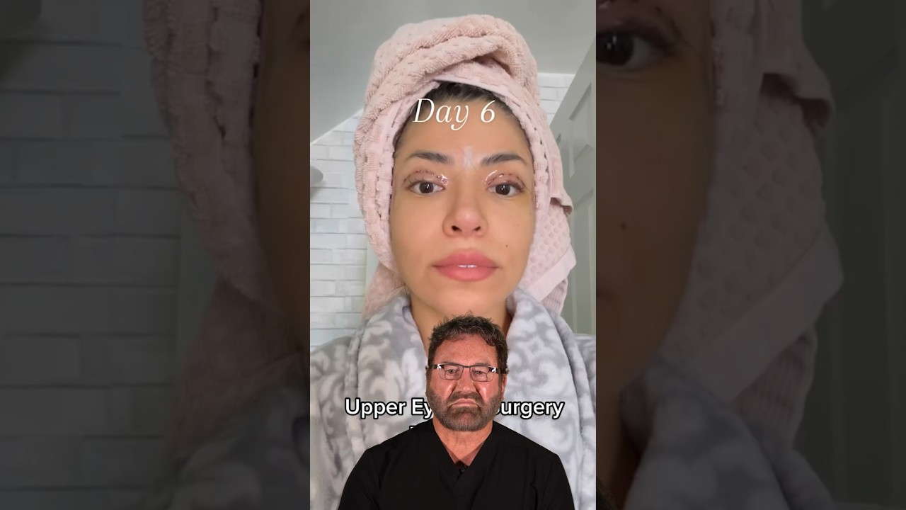 Upper Eyelid Surgery TRANSFORMATION - Surgeon Reacts