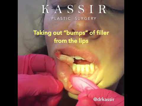 Removing “bumps” of filler from the lips