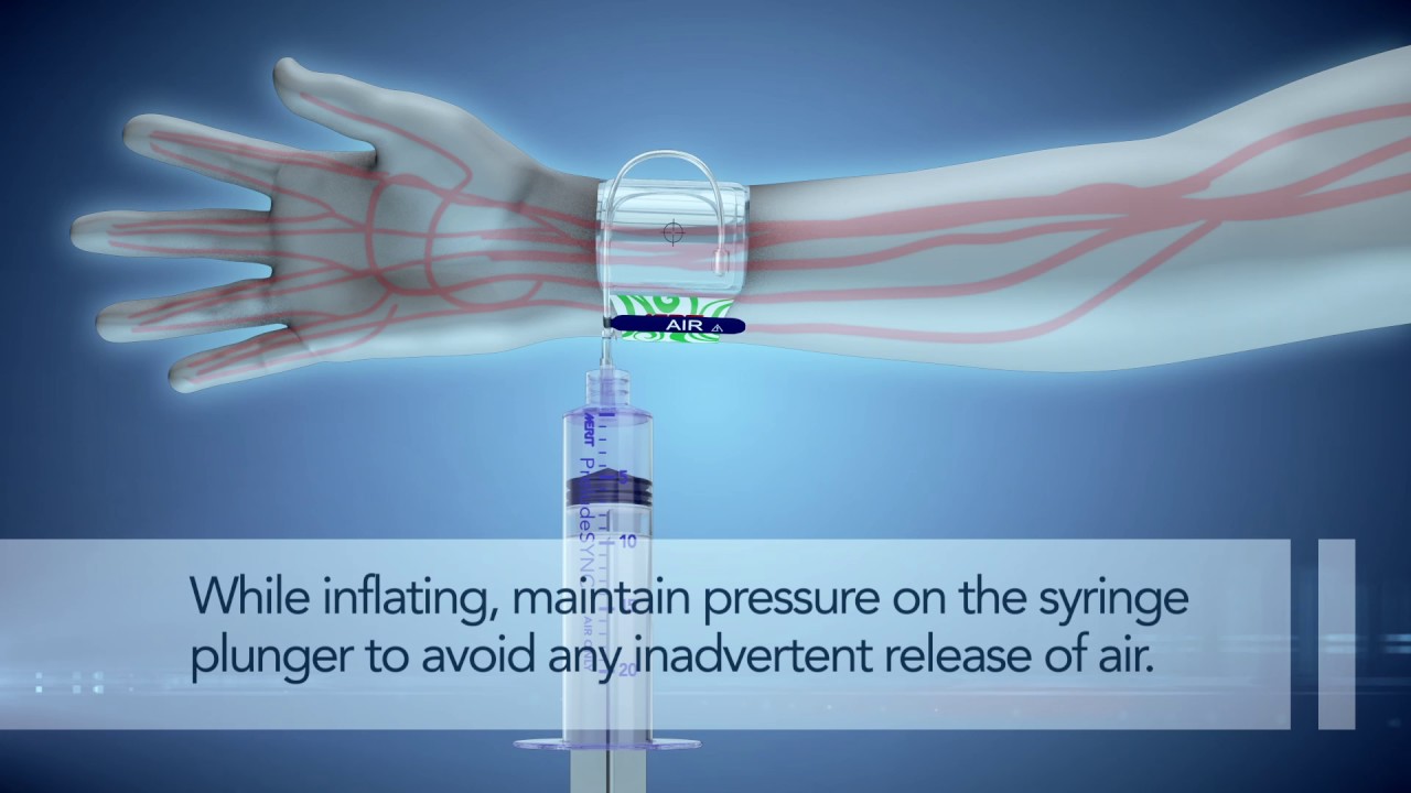 PreludeSYNC™ Radial Compression Device