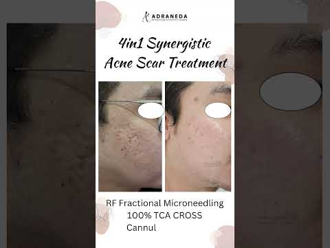 4in1 Synergistic Acne Scar Treatment RF fractional microneedling, Cannula subcision, TCA CROSS, PRP