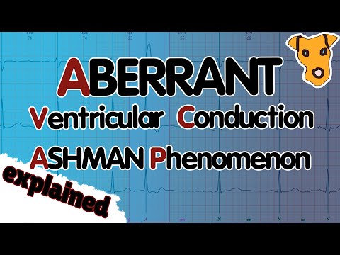 ABERRANT VENTRICULAR CONDUCTION. Ashman Phenomenon. Explained.