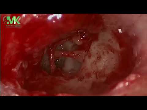 Endoscopic Left Stapedotomy