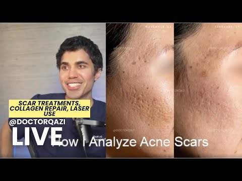 Dr. Qazi discusses: Scar Treatments, Collagen Repair, & Laser use | Unsponsored Live | 6.17.2025