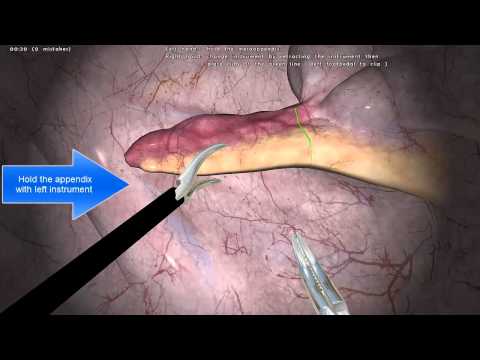 LAP-X - Appendectomy