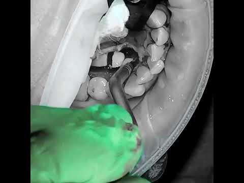 Torus Mandibularis Removal #torus #torusmandibularis #tori