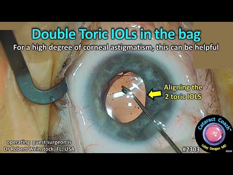 CataractCoach™ 2303: double toric IOLs in the capsular bag
