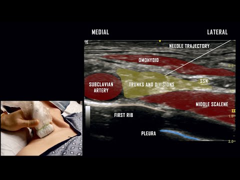 Supraclavicular Block // Ultrasound Anatomy Review