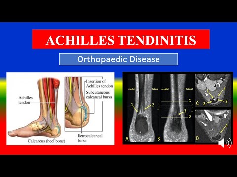 ACHILLES TENDINITIS - Definition, types, causes, pathophysiology, signs & symptoms, medicine