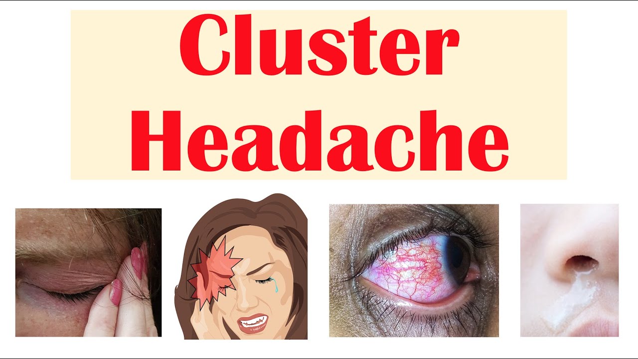 Cluster Headaches | Risk Factors, Triggers, Signs & Symptoms, Diagnosis, Treatment