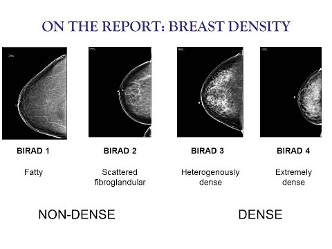 Breast Density from a Radiologist's Perspective