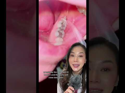 Keeping wisdom teeth clean. #wisdomteeth #wisdomtooth #whattoeatafterwisdomteeth #dentalvideo