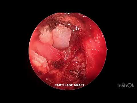 A CASE OF CSF RHINORRHEA- TRANSNASAL ENDOSCOPIC LEAK REPAIR
