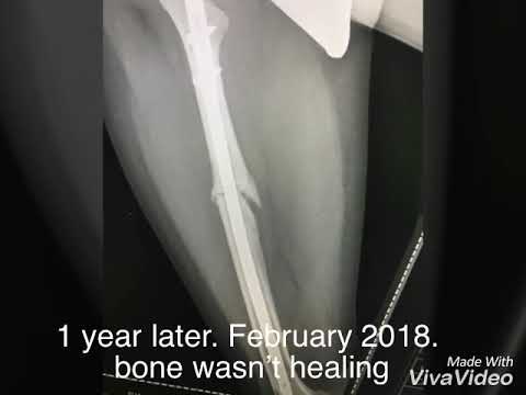 Femur fracture x-ray update