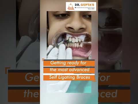 Braces Treatment | Patient Testimonial | Dr Gupta's Dental Clinic