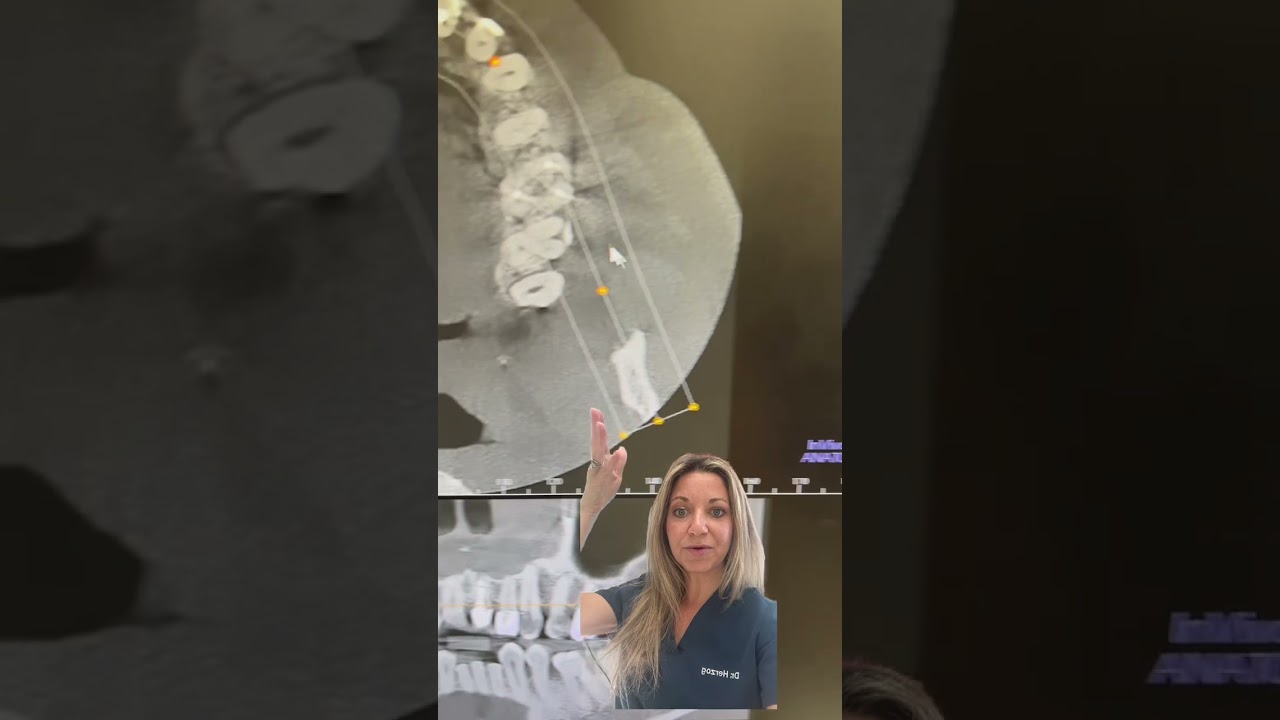 60 second guide on sinus lifts for dental implants #bonegraft #dentalimplants