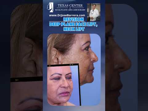 Revision Deep Plane Facelift and Neck Lift