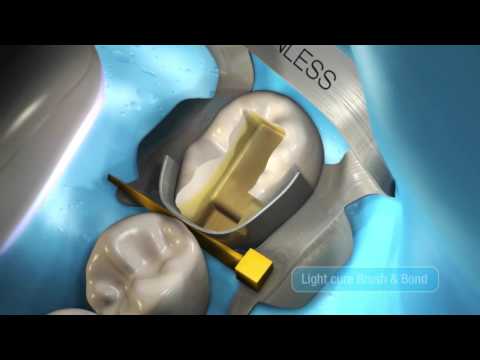 Parkell HyperFIL Bulk Fill Composite Universal Shade | Medentrx