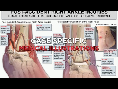 Medical Legal Illustration for Injury Cases - MedLegalVisuals®