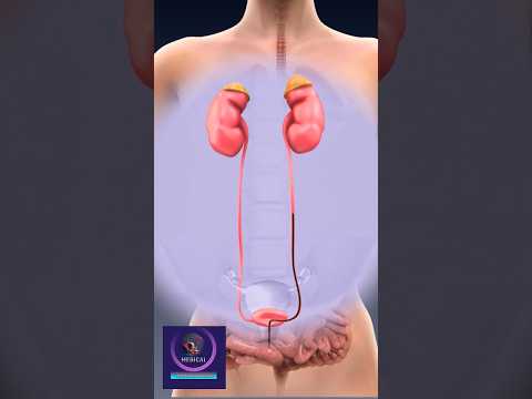 Laser Lithotripsy for Kidney Stones: Breaking Stones with Ureteroscopy