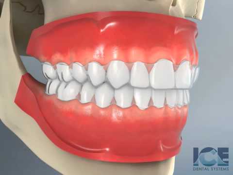 New Image Dentistry shares Invisalign in Omaha, NE
