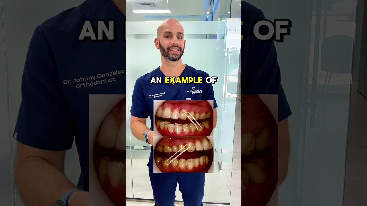 Can Invisalign be used with rubber bands? And do I need rubber bands with my treatment?