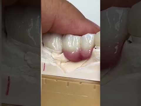 With pink esthetic #dental #bridge #viralshort #shorts