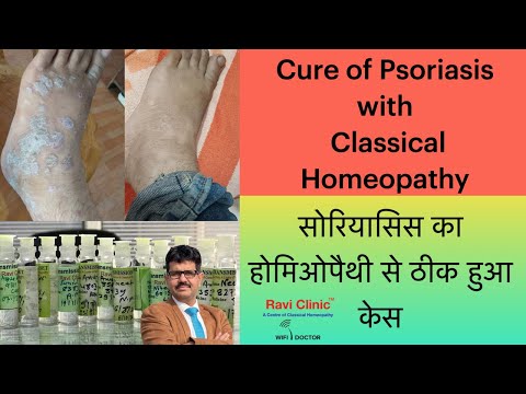 A case of Psoroasis healed with homeopathy Dr Ravi Singh