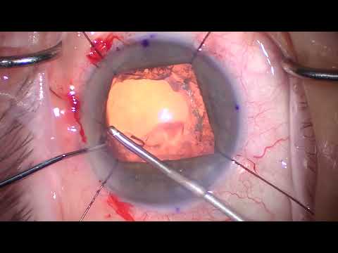 Complicated Cataract surgery. 1 piece IOL in sulcus UGH replaced for optic captured 3 piece
