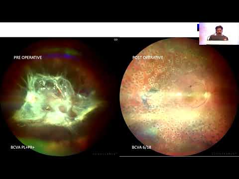 AIOS2025 GP35 T Dr Sangeet MITTAL Tips and Tricks in the Management of Diabetic Tractional Retinal D