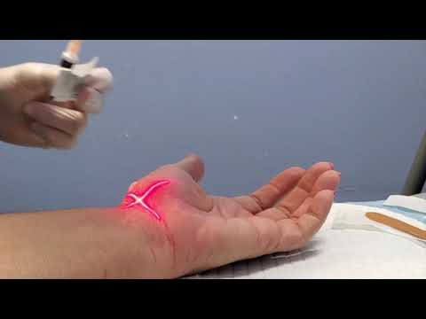 Thumb Carpometacarpal Joint Steroid Injection