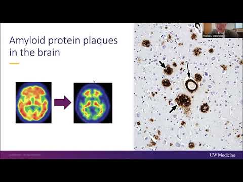An Update on Lecanemab for Early Stage Alzheimer’s Disease
