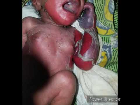 Staphylococal scalded skin syndrome, SSSS