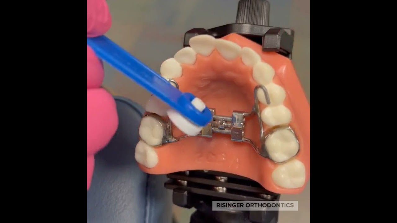 How To Turn Your Expander ( Rapid Palatal Expander)