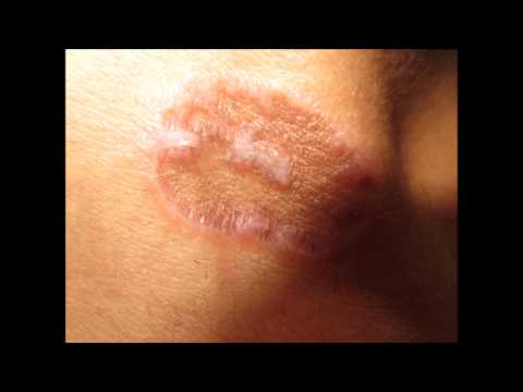 Actinic Lichen Planus