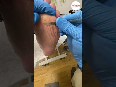 Corns on forefoot causing pain: scalpel removal