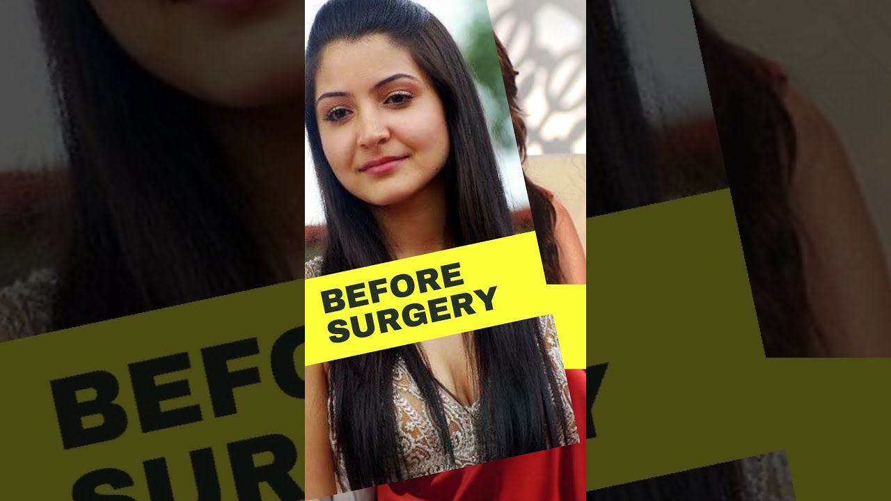 Anushka Sharma Before And After Plastic Surgery